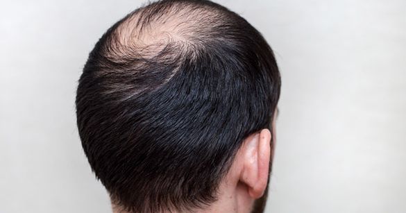 Haartransplantation bei Tonsur in Wien / St. Pölten